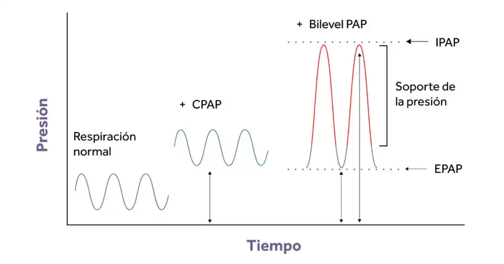 ¿Una O Dos Presiones?: Las Diferencias Entre La CPAP Y La PAP Binivel ...