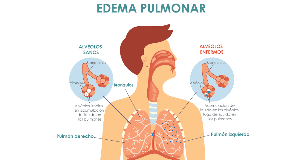 Líquido En Los Pulmones: Causas Y Tratamiento | Eakin Respiratory